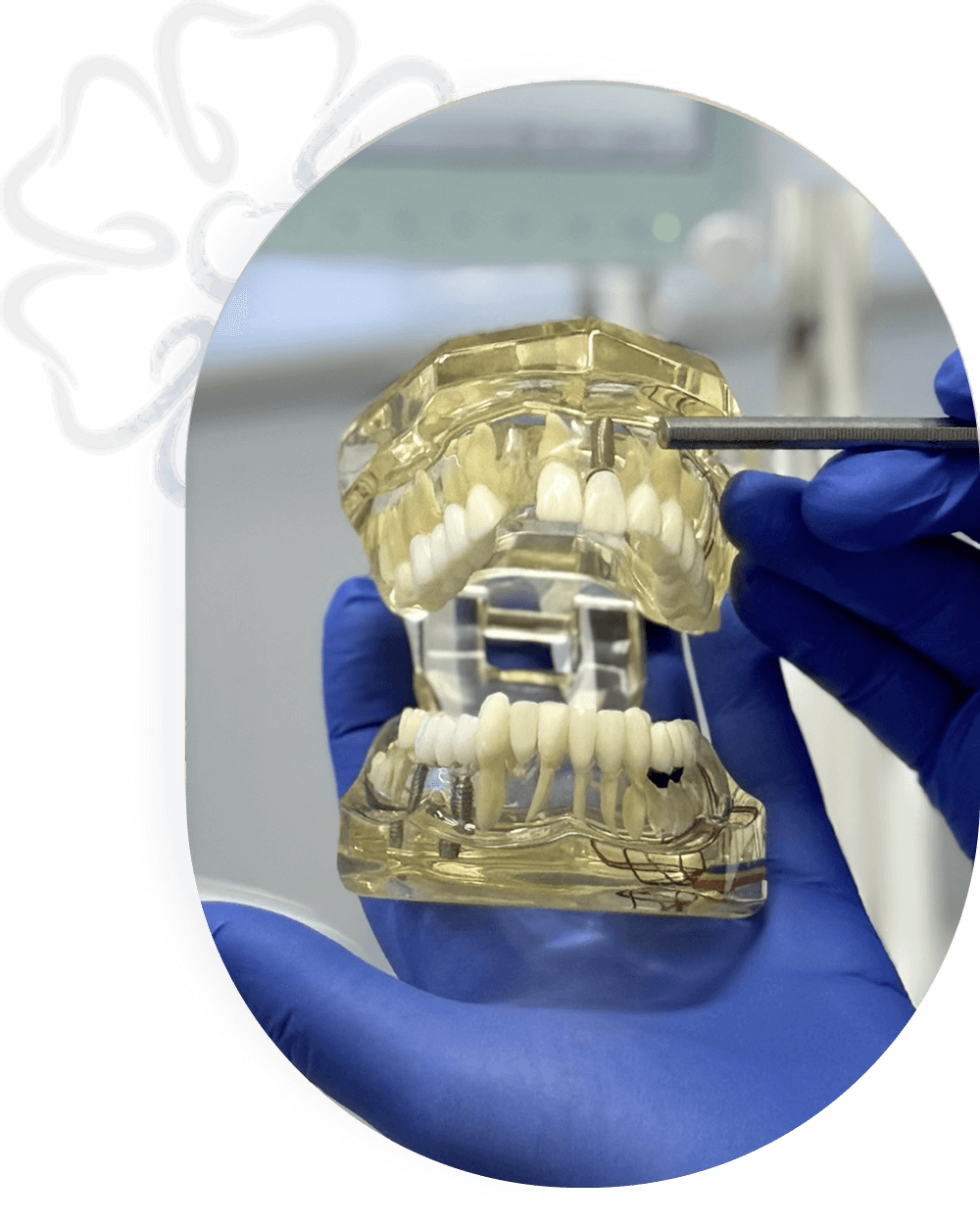 Dental Implants Port Macquarie | Missing Teeth Solution